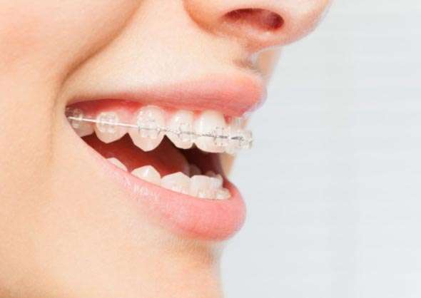 Clear Braces Sydney, Invisible Braces Cost - Smile Concepts