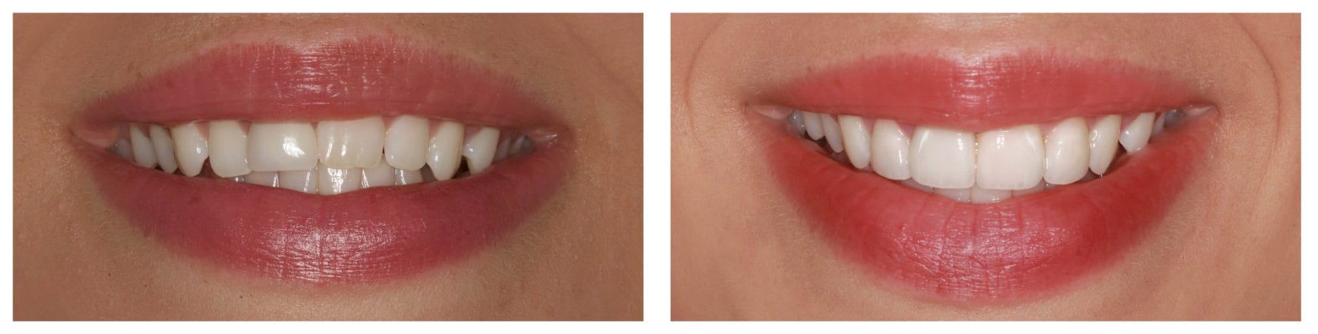 Porcelain Veneers Sydney - Natural Looking Dental Veneers