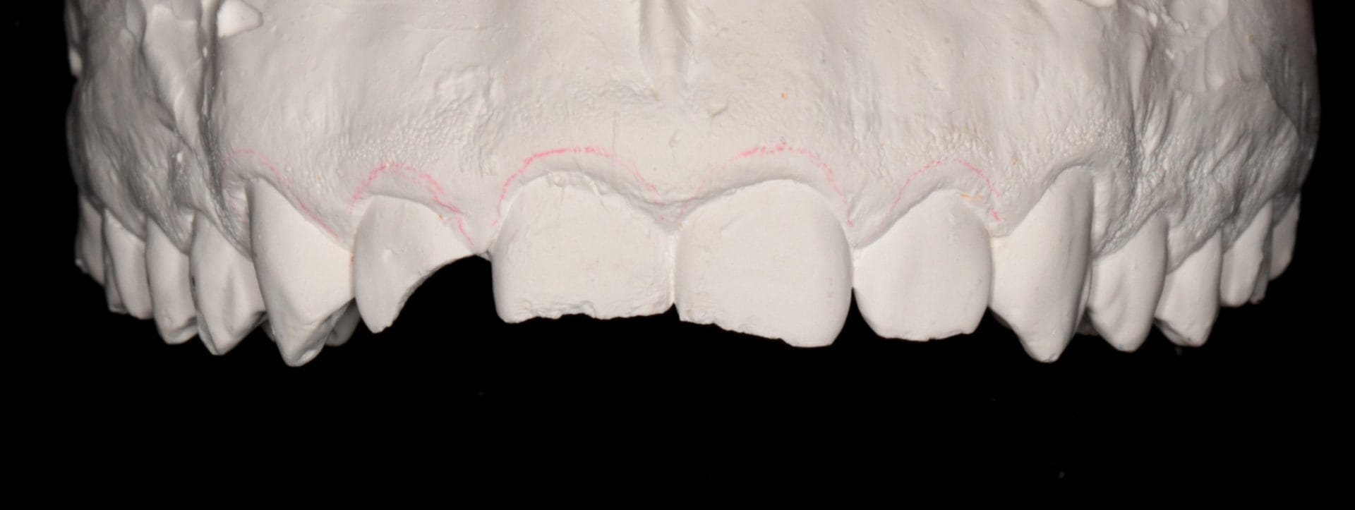 Porcelain Veneers Sydney - Natural Looking Dental Veneers