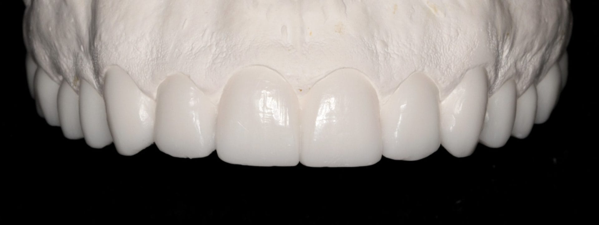 Porcelain Veneers Sydney - Natural Looking Dental Veneers