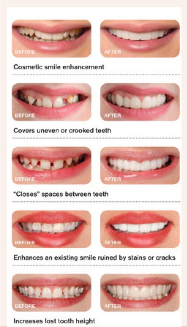 Snap On Smile, Transform Your Smile | Smile Concepts