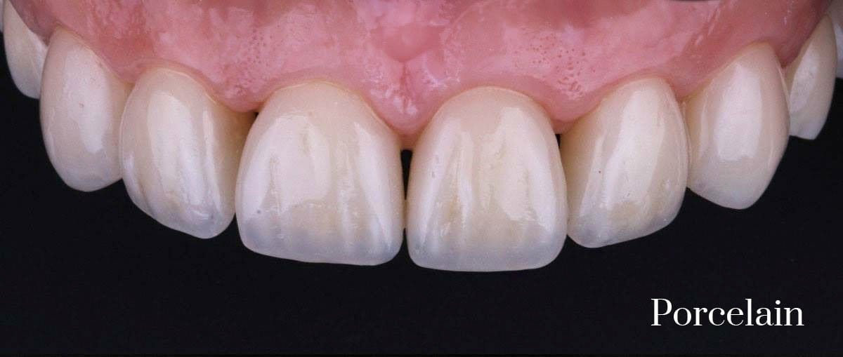 Composite Veneers Sydney & Composite Veneer Cost | Smile Concepts