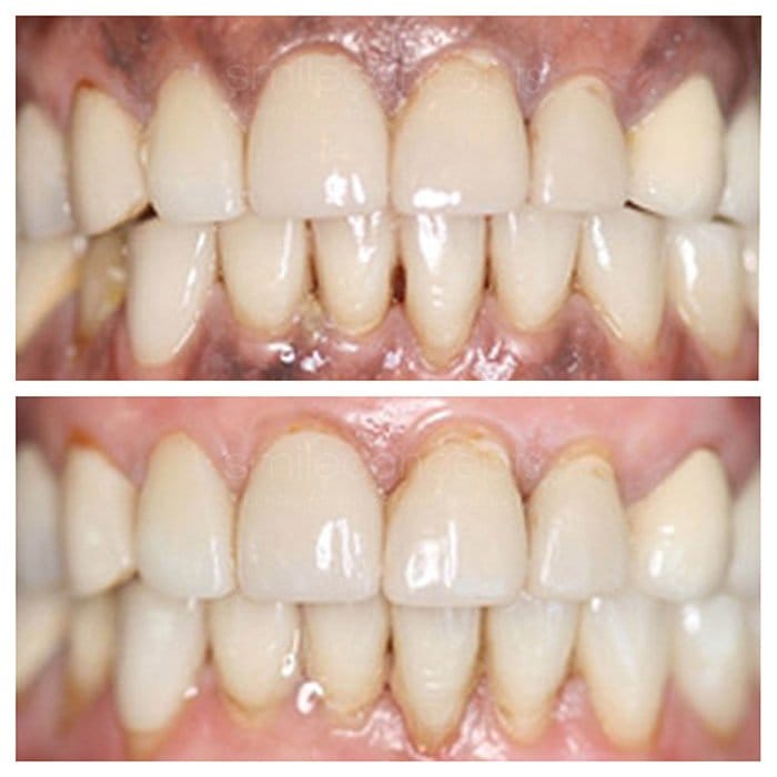 Gum Bleaching, Before & After Photos | Smile Concepts
