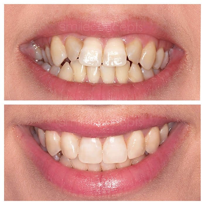 Teeth Straightening From $40/Week | Invisible Options Available