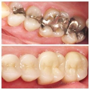 Old Fillings, Decay & Broken Teeth | Smile Concepts