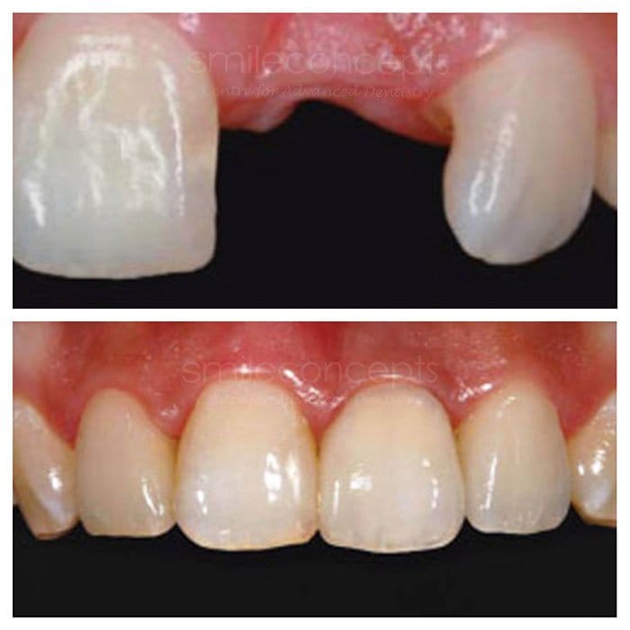One Tooth Missing, Before & After Photos | Smile Concepts
