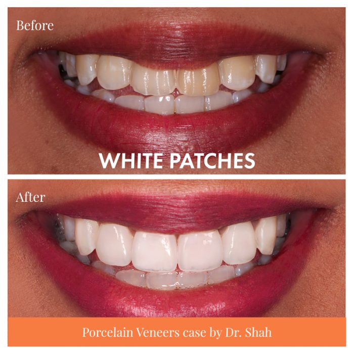 7 Tips for Choosing the Perfect Colour for your Veneers (Updated 2021)