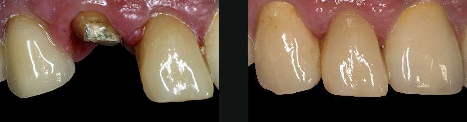 All Teeth Missing, Before & After Photos | Smile Concepts
